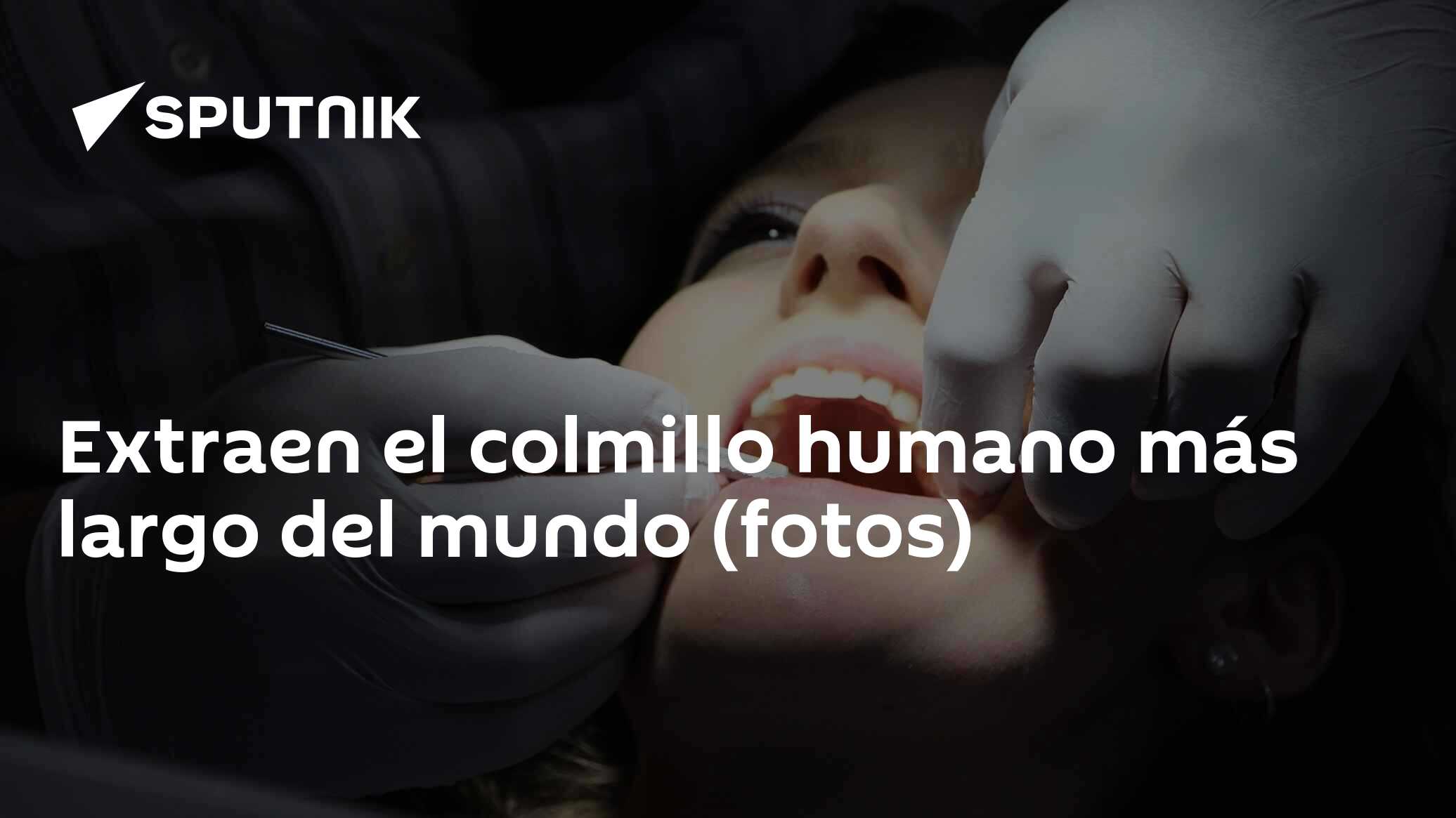 Extraen el colmillo humano más largo del mundo (fotos) - 18.07.2017 ...